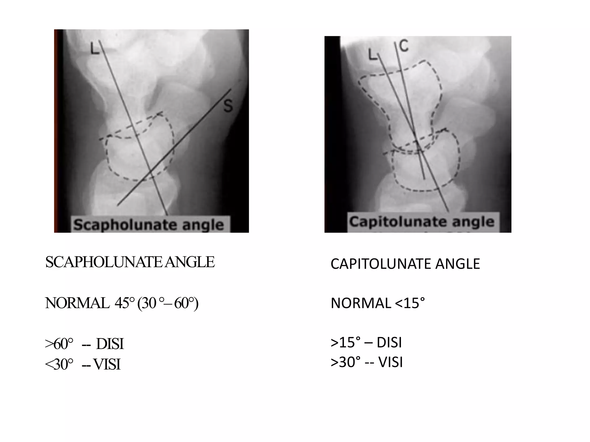 Scaphoid fracture and non union | PPTX