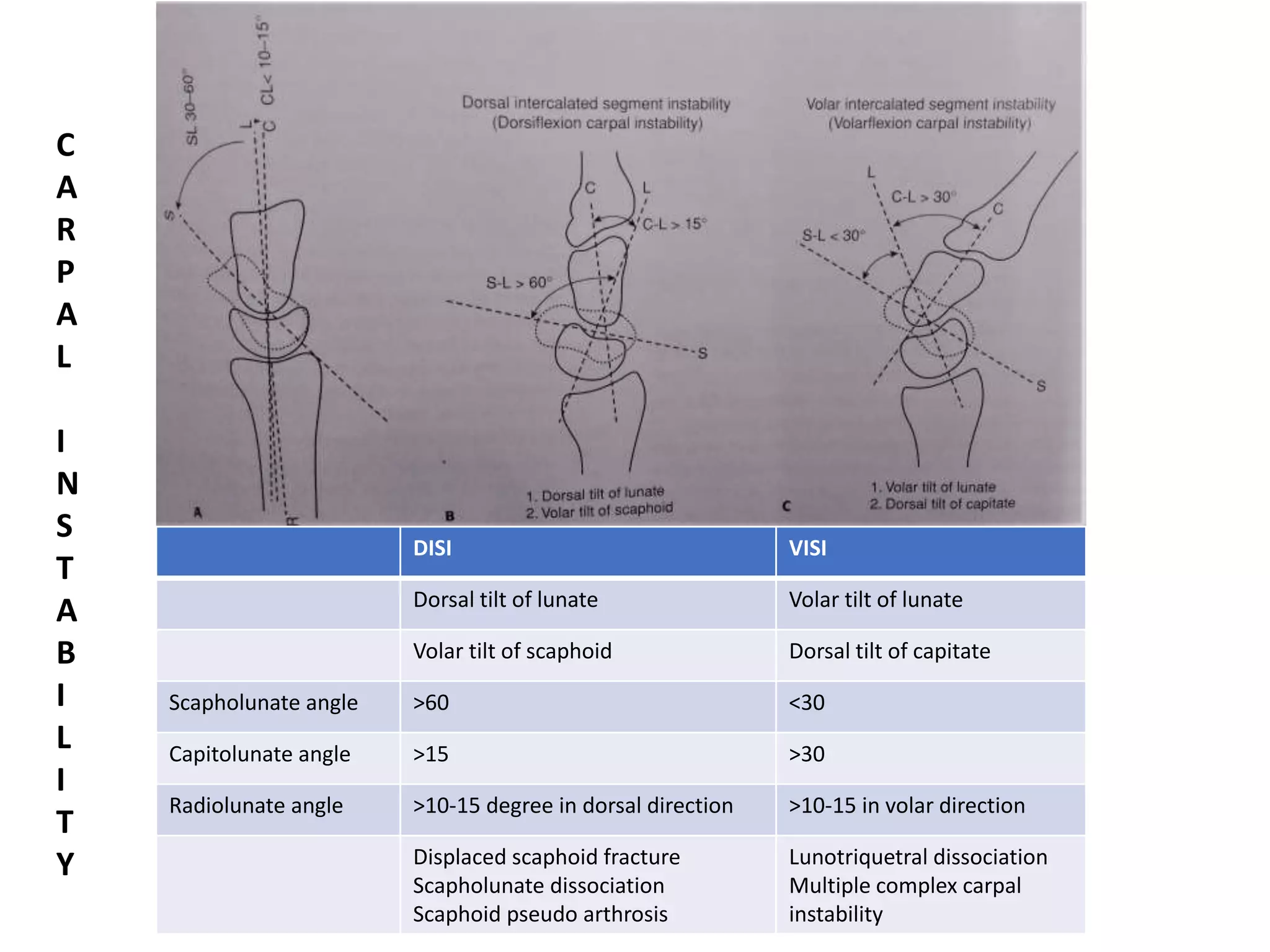 Scaphoid fracture and non union | PPTX