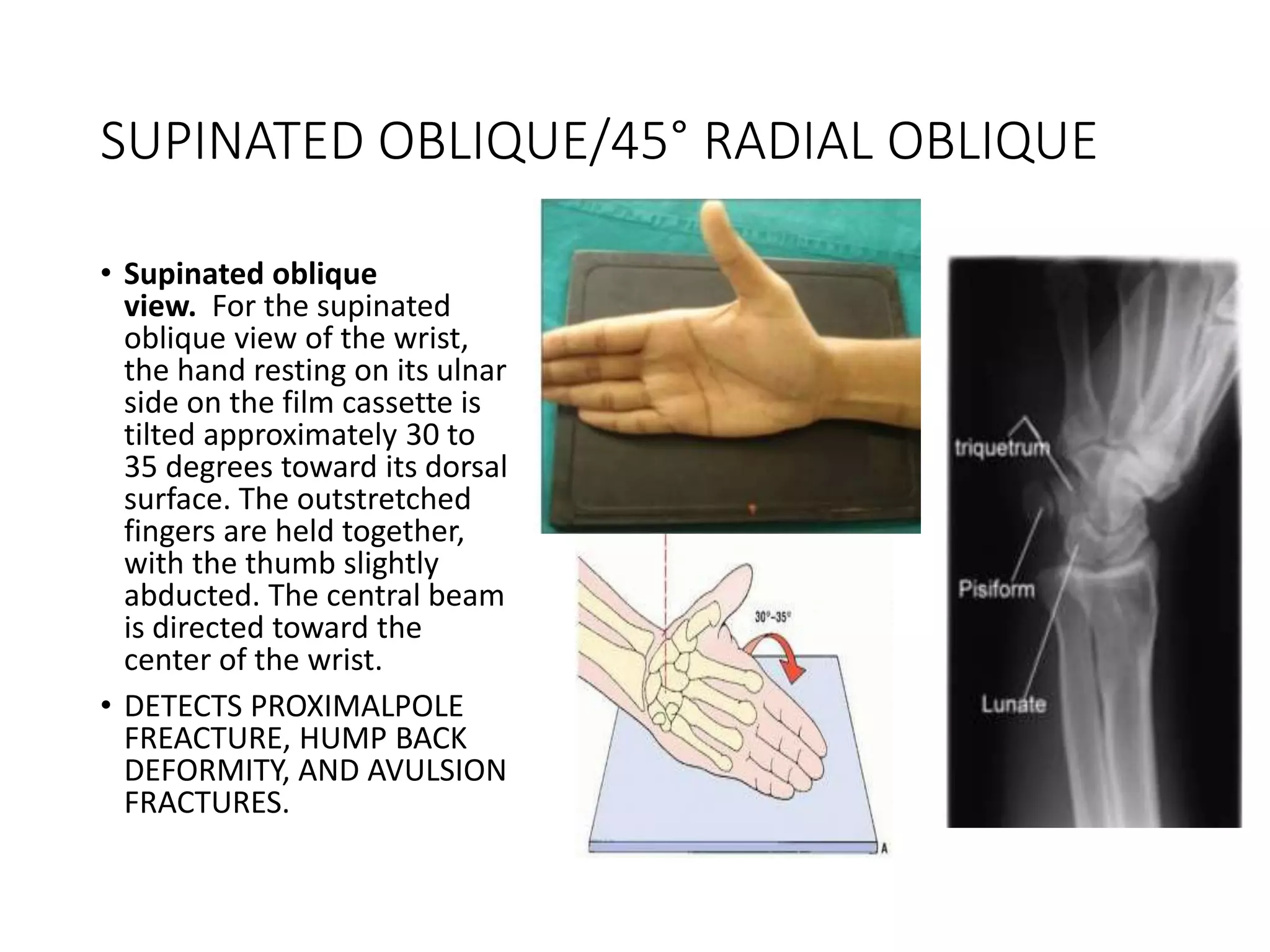 Scaphoid fracture and non union | PPTX