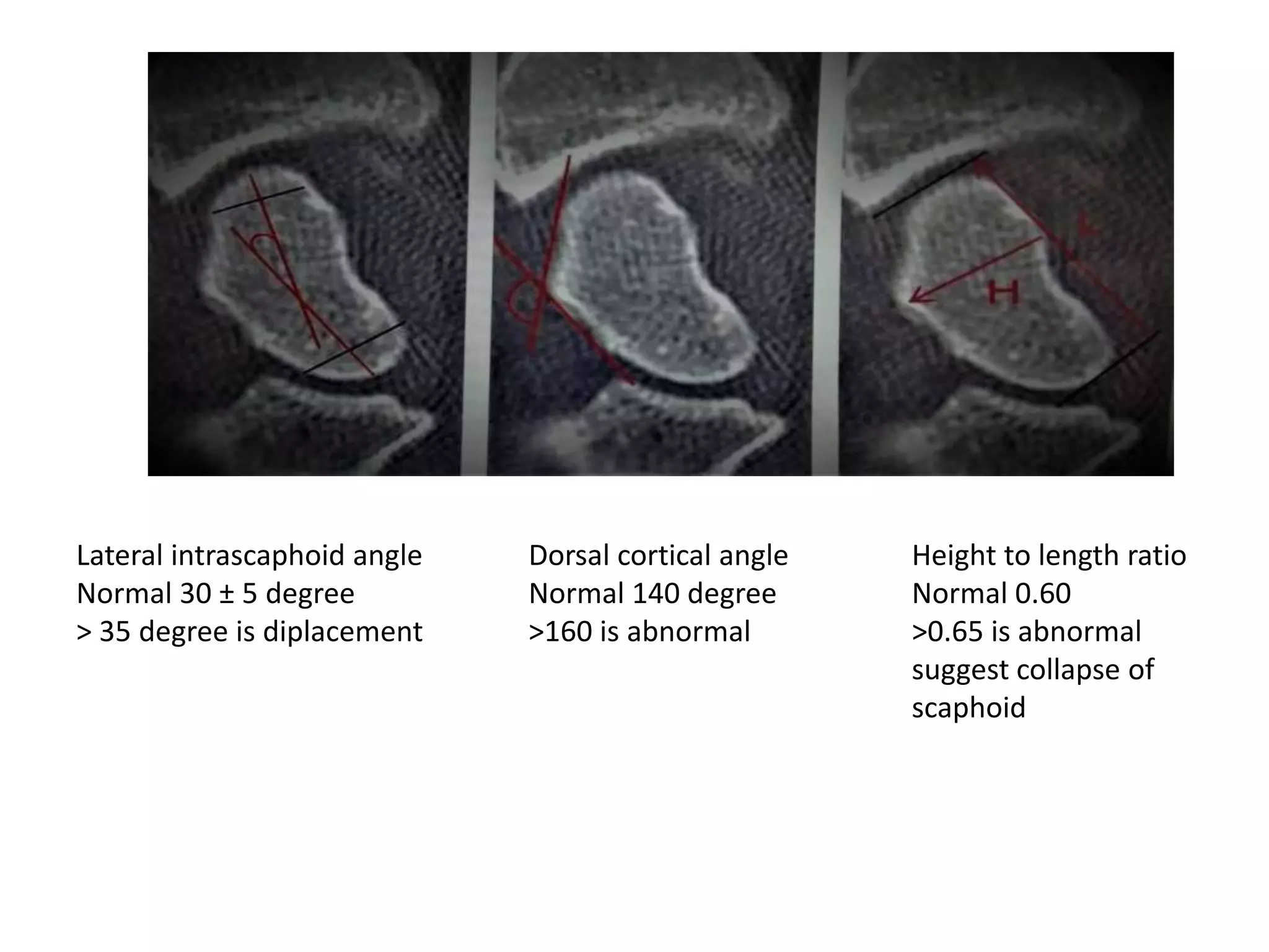 Scaphoid fracture and non union | PPTX