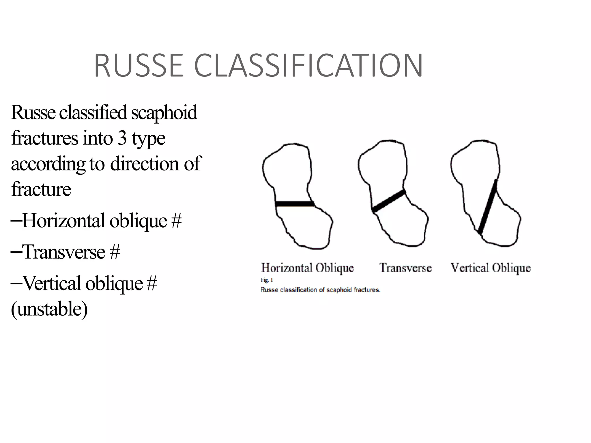 Scaphoid fracture and non union | PPTX