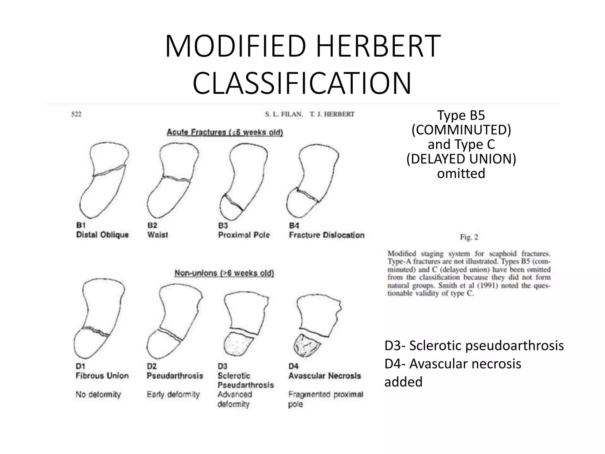 Scaphoid fracture and non union | PPTX