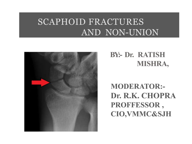 Scaphoid fracture and non union | PPTX