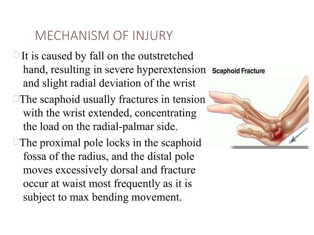 Scaphoid fracture and non union | PPTX