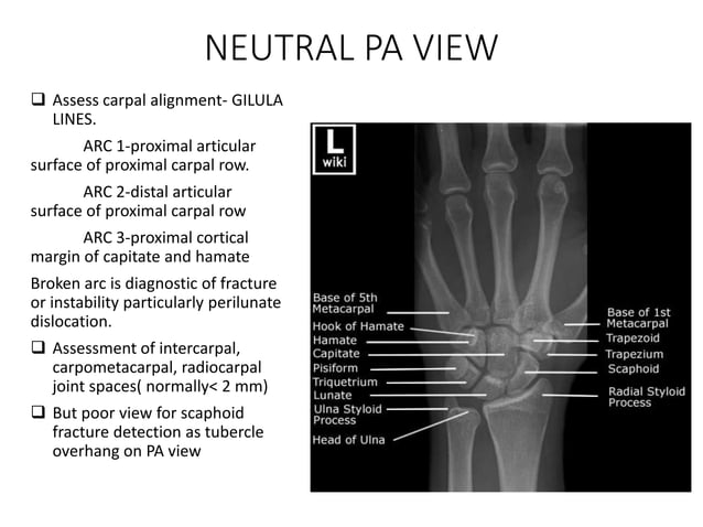 Scaphoid fracture and non union | PPTX