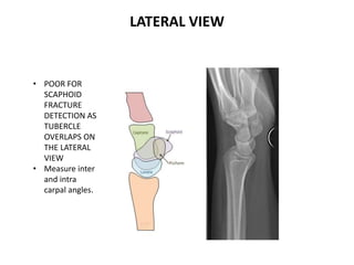 Scaphoid fracture and non union | PPTX