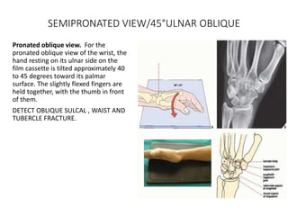 Scaphoid fracture and non union | PPTX