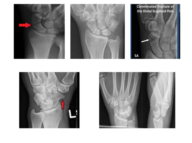 Scaphoid fracture and non union | PPTX