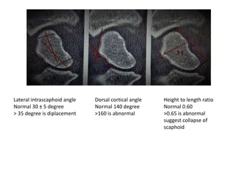 Scaphoid fracture and non union | PPTX