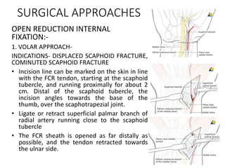 Scaphoid fracture and non union | PPTX