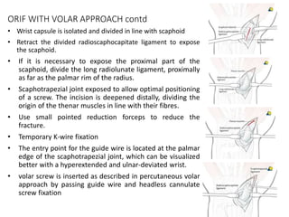 Scaphoid fracture and non union | PPTX