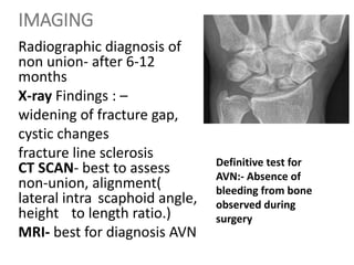 Scaphoid fracture and non union | PPTX