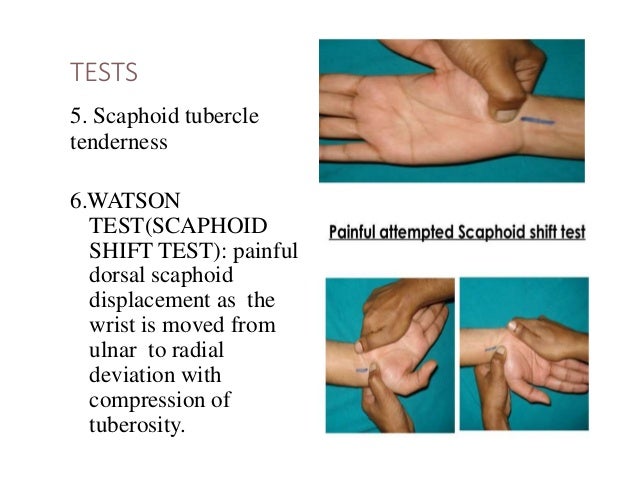 Scaphoid fracture and non union