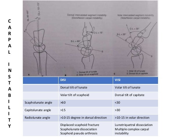 Scaphoid fracture and non union