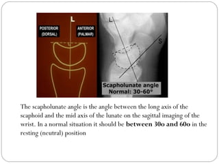 Scaphoid fracture and nonunion | PPT