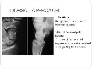 Scaphoid fracture and nonunion | PPT