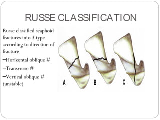 Scaphoid Fracture Classification