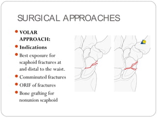 Scaphoid fracture and nonunion | PPT