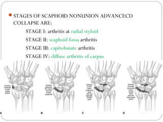 Scaphoid Fossa Wrist