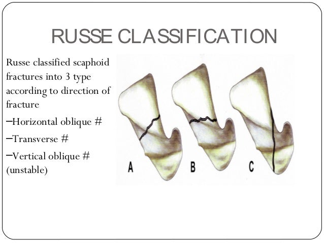 Scaphoid fracture and nonunion