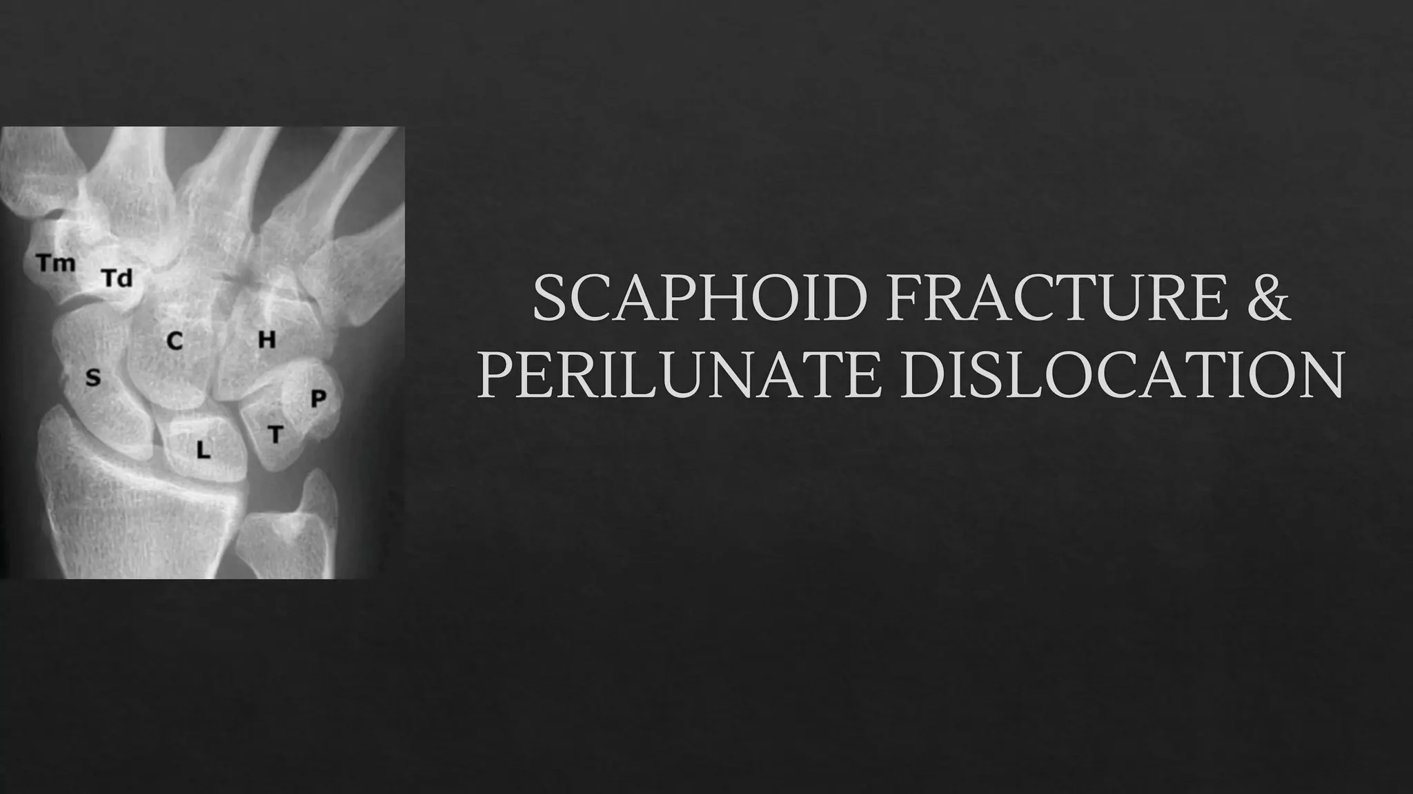 Scaphoid fracture and perilunate dislocation | PDF