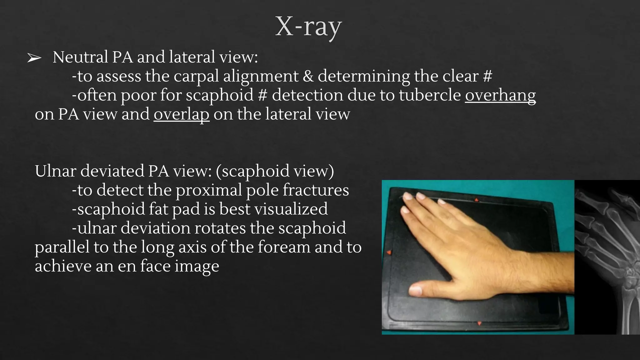 Scaphoid fracture and perilunate dislocation | PDF