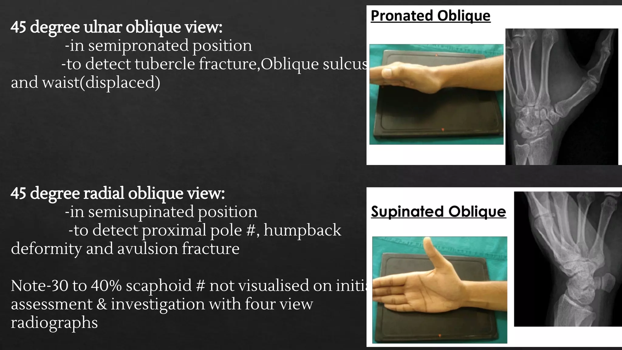 Scaphoid fracture and perilunate dislocation | PDF | Death, Injury, or ...