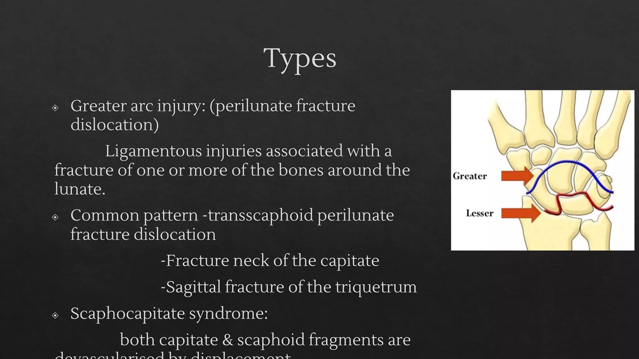 Scaphoid fracture and perilunate dislocation | PPT