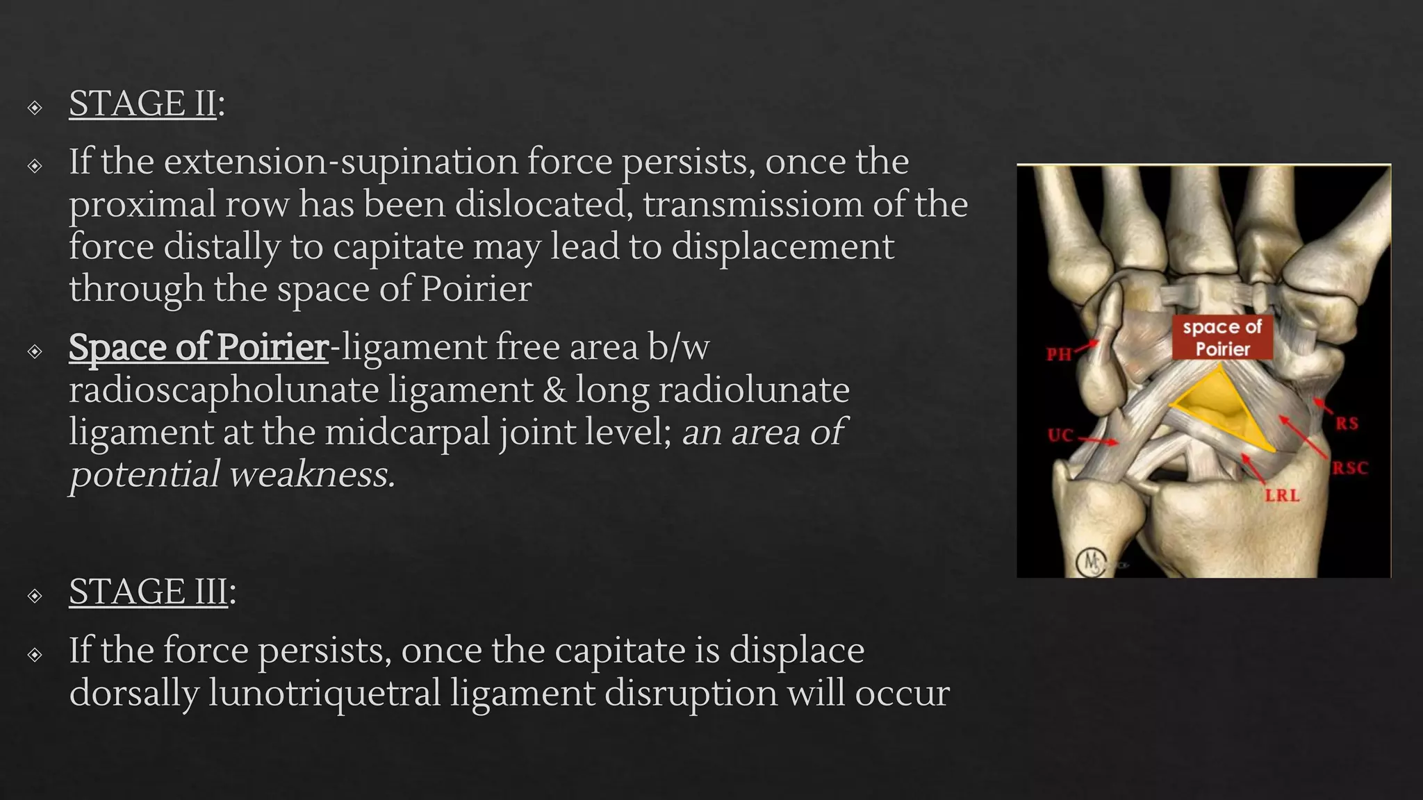Scaphoid fracture and perilunate dislocation | PDF | Death, Injury, or ...