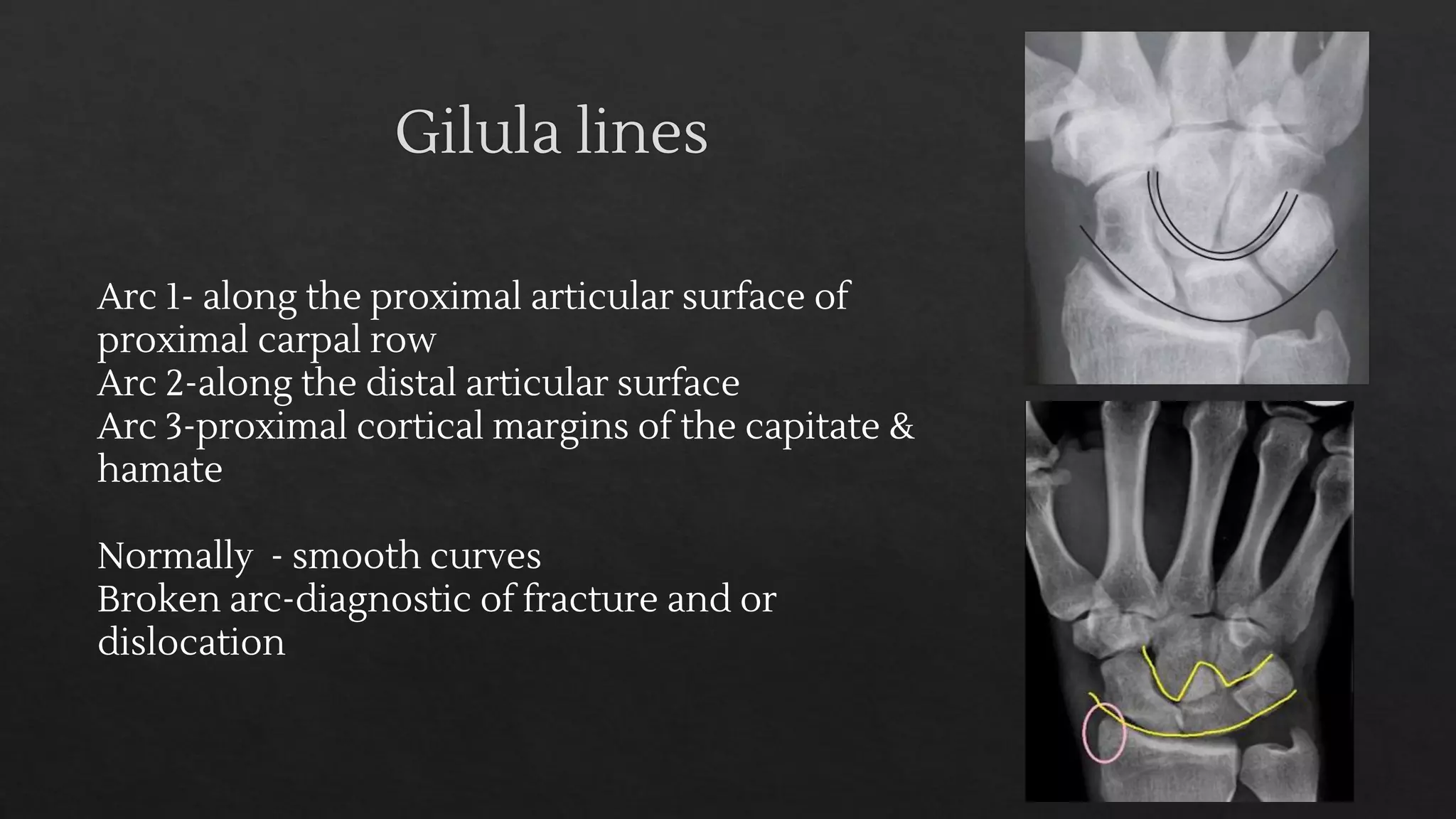 Scaphoid fracture and perilunate dislocation | PDF | Death, Injury, or ...