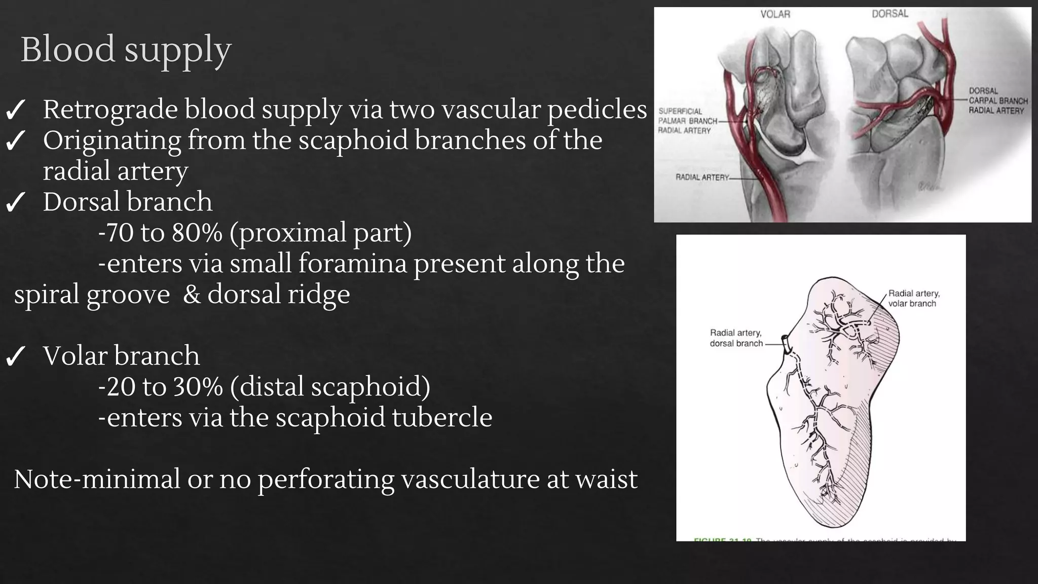 Scaphoid fracture and perilunate dislocation | PDF
