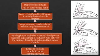 Scaphoid fracture and perilunate dislocation | PDF