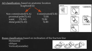 Scaphoid fracture and perilunate dislocation | PDF