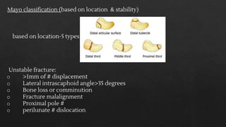 Scaphoid fracture and perilunate dislocation | PDF