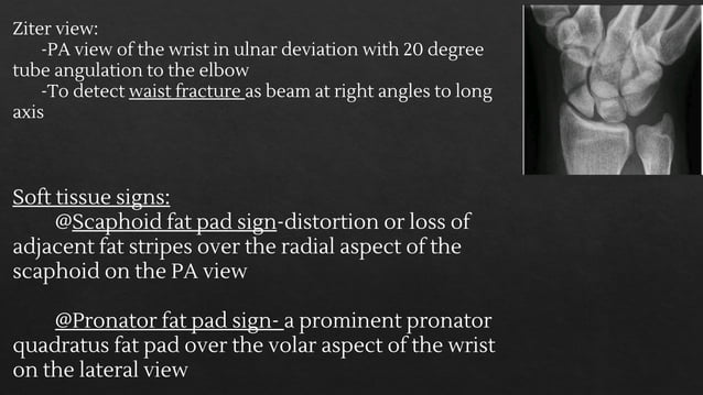 Scaphoid fracture and perilunate dislocation | PDF | Death, Injury, or ...