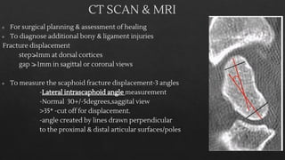 Scaphoid fracture and perilunate dislocation | PDF