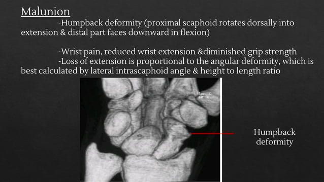 Scaphoid fracture and perilunate dislocation | PDF | Death, Injury, or ...
