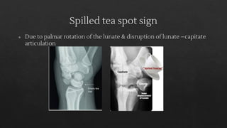 Scaphoid fracture and perilunate dislocation | PDF