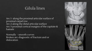 Scaphoid fracture and perilunate dislocation | PDF