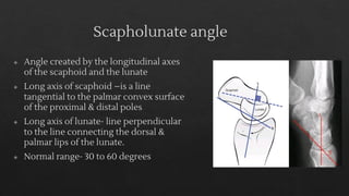Scaphoid fracture and perilunate dislocation | PDF