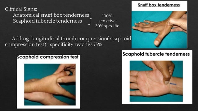 Scaphoid fracture and perilunate dislocation