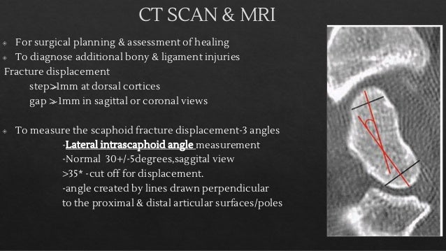 Scaphoid fracture and perilunate dislocation