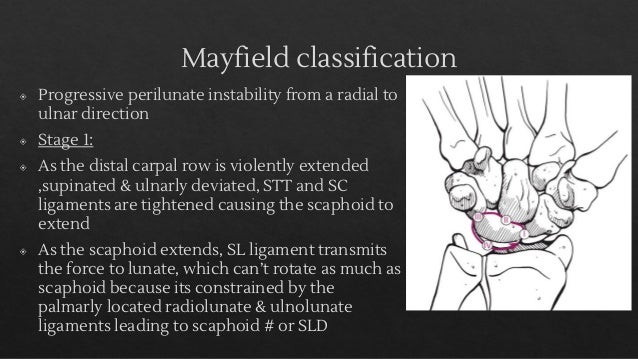 Scaphoid fracture and perilunate dislocation