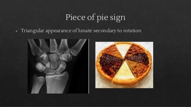 Scaphoid fracture and perilunate dislocation