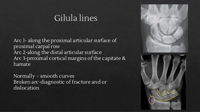 Scaphoid fracture and perilunate dislocation