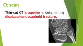 scaphoid fracture physical therapy presentation.pptx