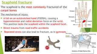 scaphoid fracture physical therapy presentation.pptx