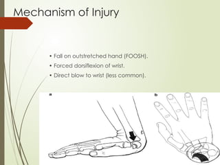 Scaphoid_Fracture_Presentation slides.pptx