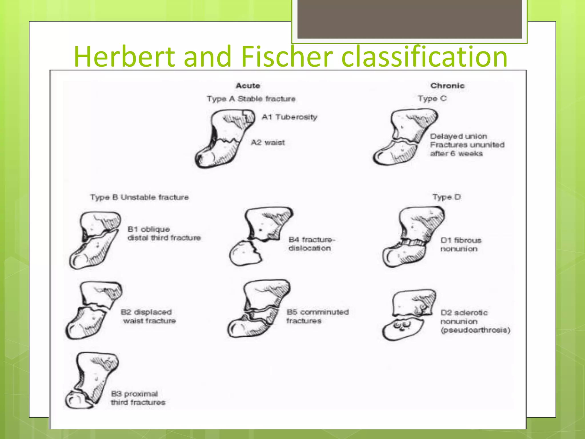 Scaphoid fractures | PPTX