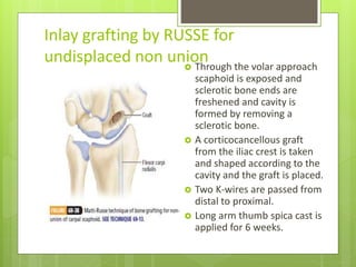 Scaphoid fractures | PPTX